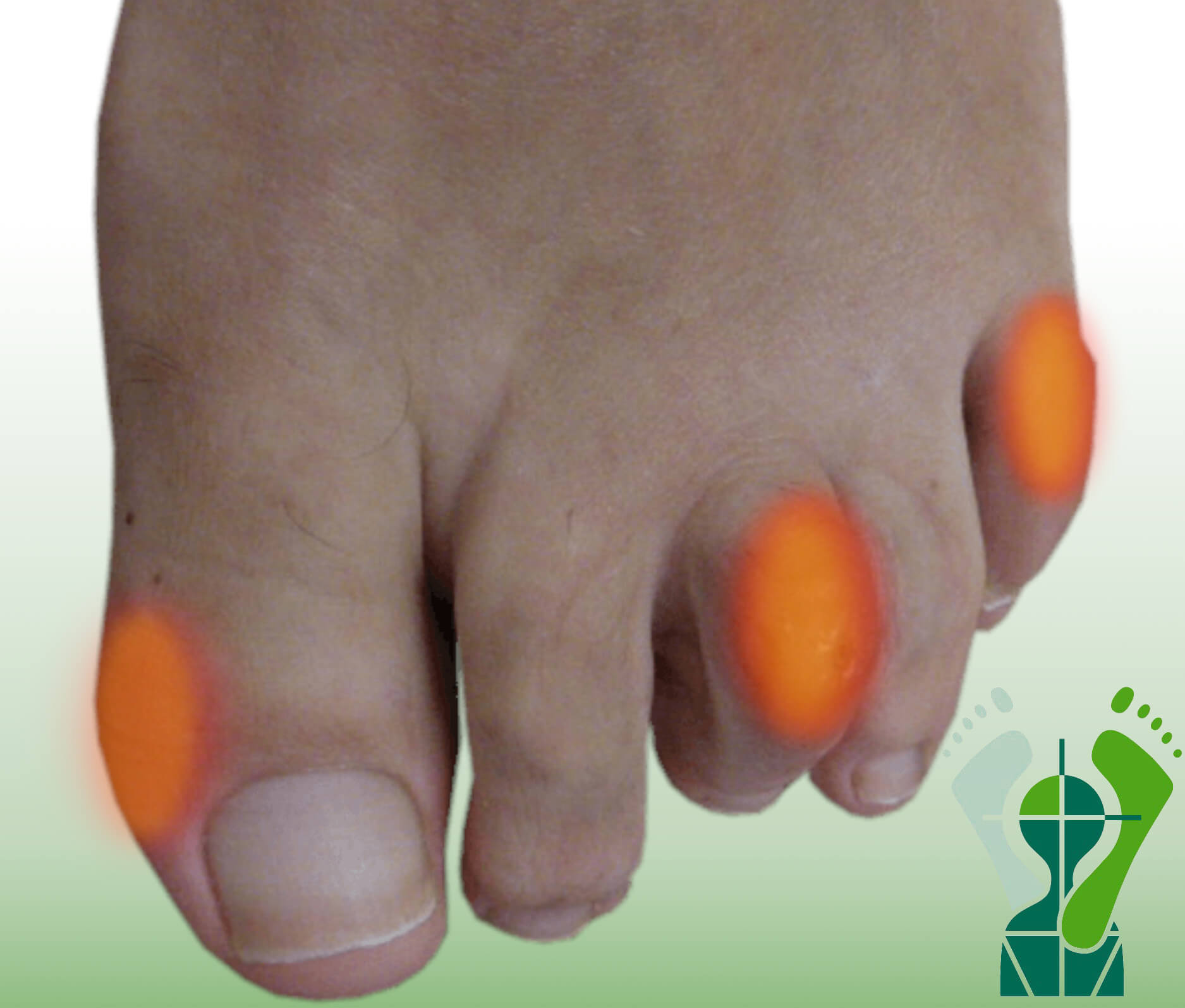 Drukplekken aan de tenen - Podocentrum Heerhugowaard