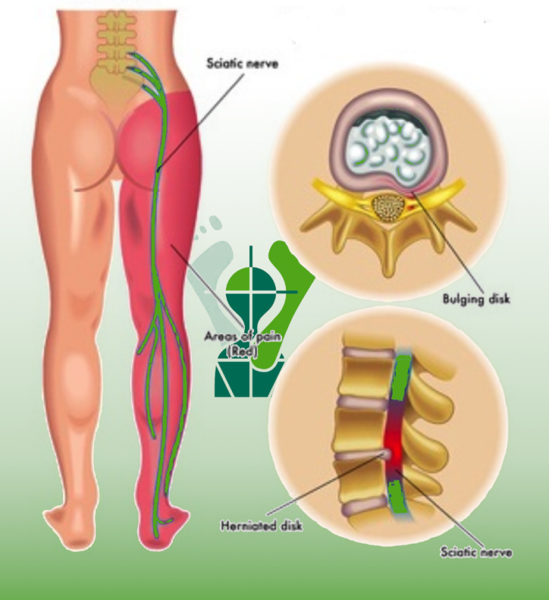Een Hernia Nucleus Pulposa (HNP) - Podocentrum Heerhugowaard