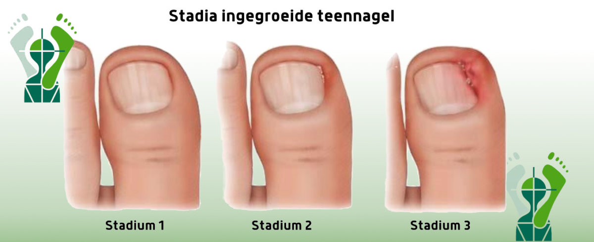 Ingegroeide teennagel - Podocentrum Heerhugowaard