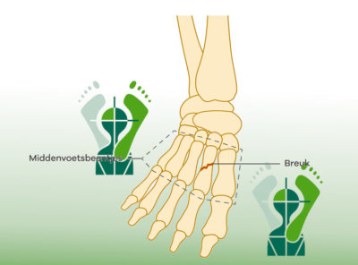 Een gebroken middenvoetsbeentje - Podocentrum Heerhugowaard