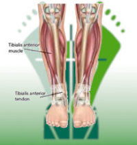 Overbelasting voorste scheenbeenspier (m. tibialis anterior ...